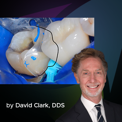 Créer la restauration idéale en résine de classe II – Clinical Research ...