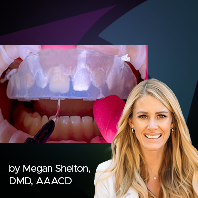 Using Injection Molding Composite Veneers as a Transitional Guide Duri ...