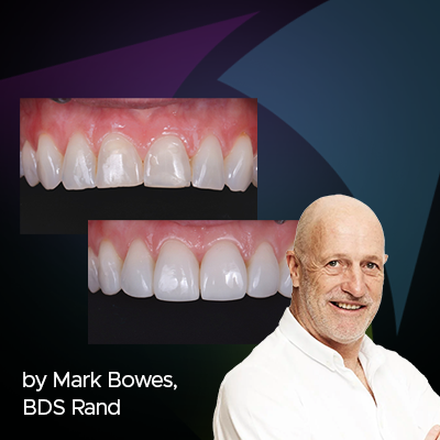 Facially Driven, Single Opacity Composite Veneers – Clinical Research ...